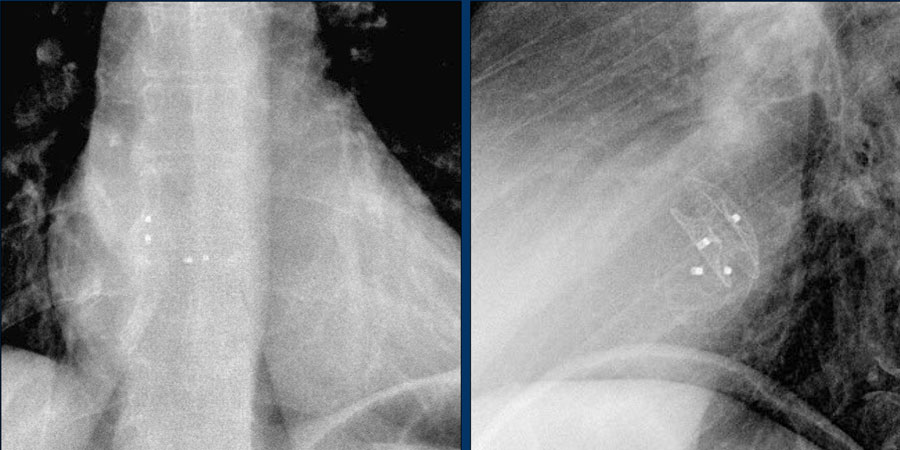 The Radiology Assistant : Cardiovascular devices