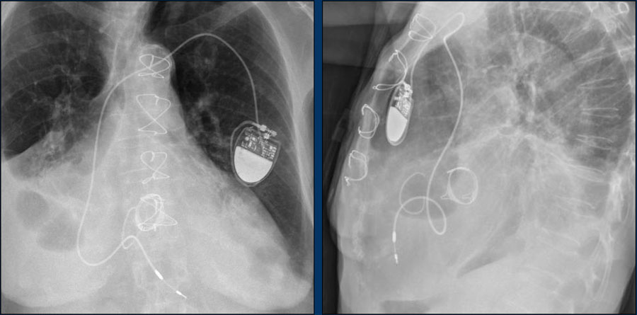 The Radiology Assistant : Cardiovascular devices
