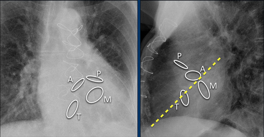 The Radiology Assistant Cardiovascular Devices Free Download Nude The Radiology Assistant Cardiovascular Devices Free Download Nude
