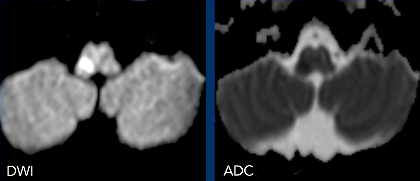 The Radiology Assistant : Horner syndrome