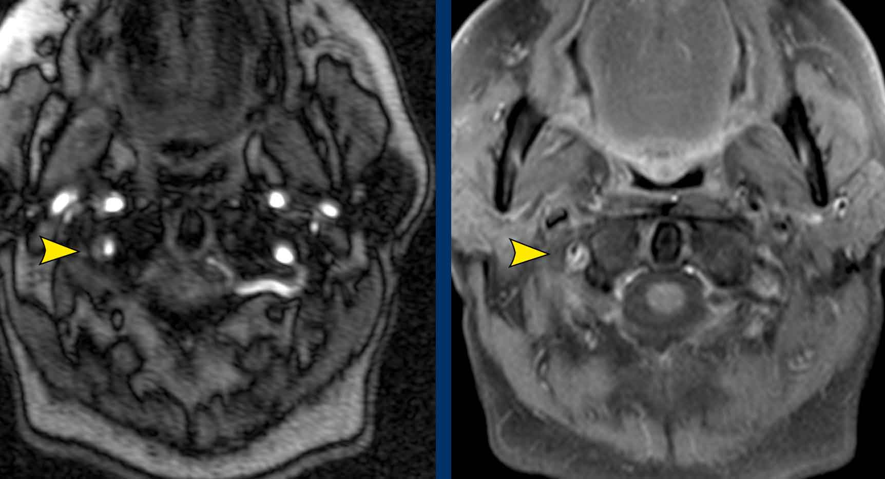 The Radiology Assistant : Horner syndrome.