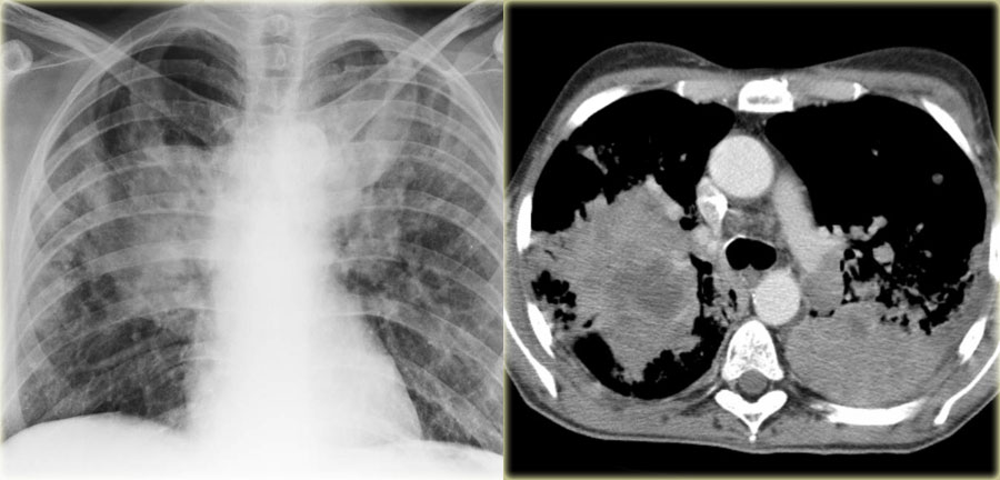The Radiology Assistant : Chest X-Ray - Lung disease