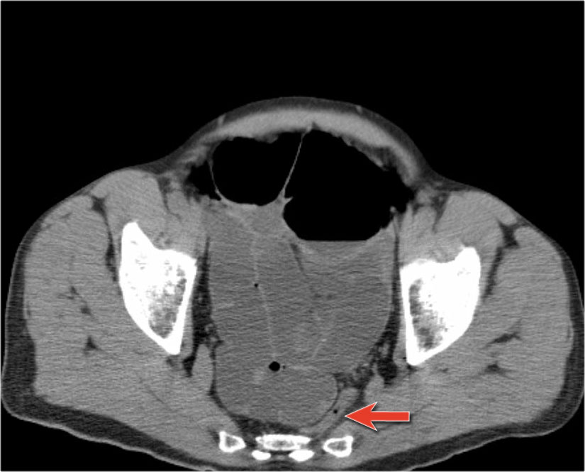 The Radiology Assistant : Closed Loop in Small bowel obstruction
