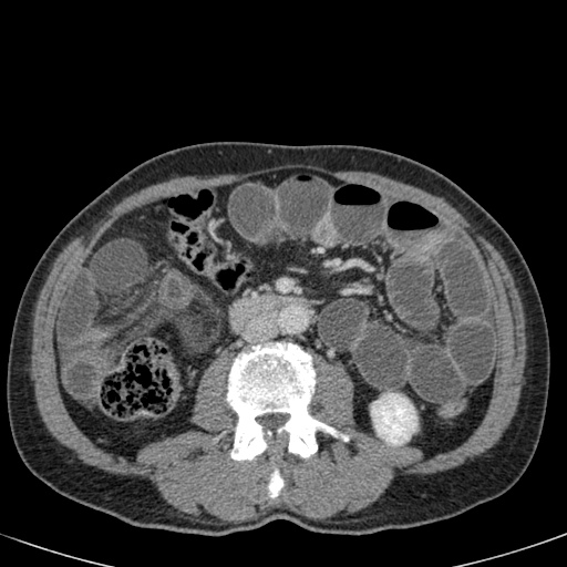 The Radiology Assistant : Closed Loop Obstruction in Small bowel ...