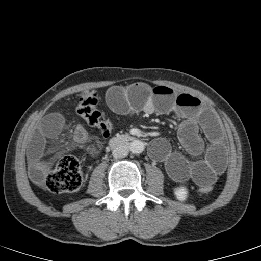 The Radiology Assistant : Closed Loop Obstruction in Small bowel ...