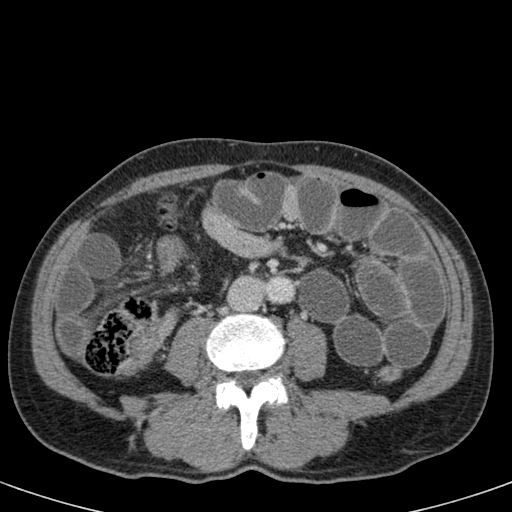 The Radiology Assistant : Closed Loop Obstruction in Small bowel ...