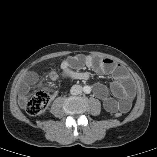 The Radiology Assistant : Closed Loop Obstruction in Small bowel ...