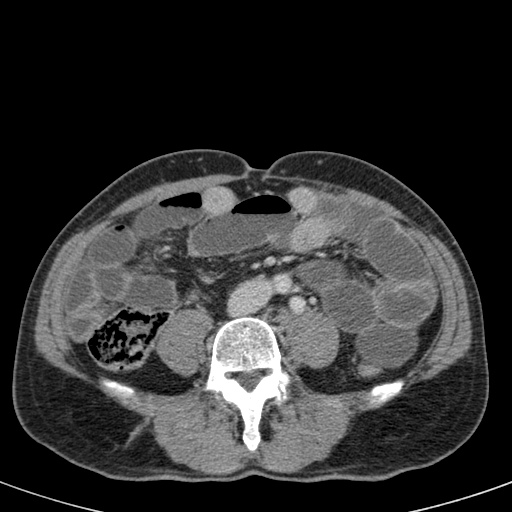 The Radiology Assistant : Closed Loop Obstruction in Small bowel ...