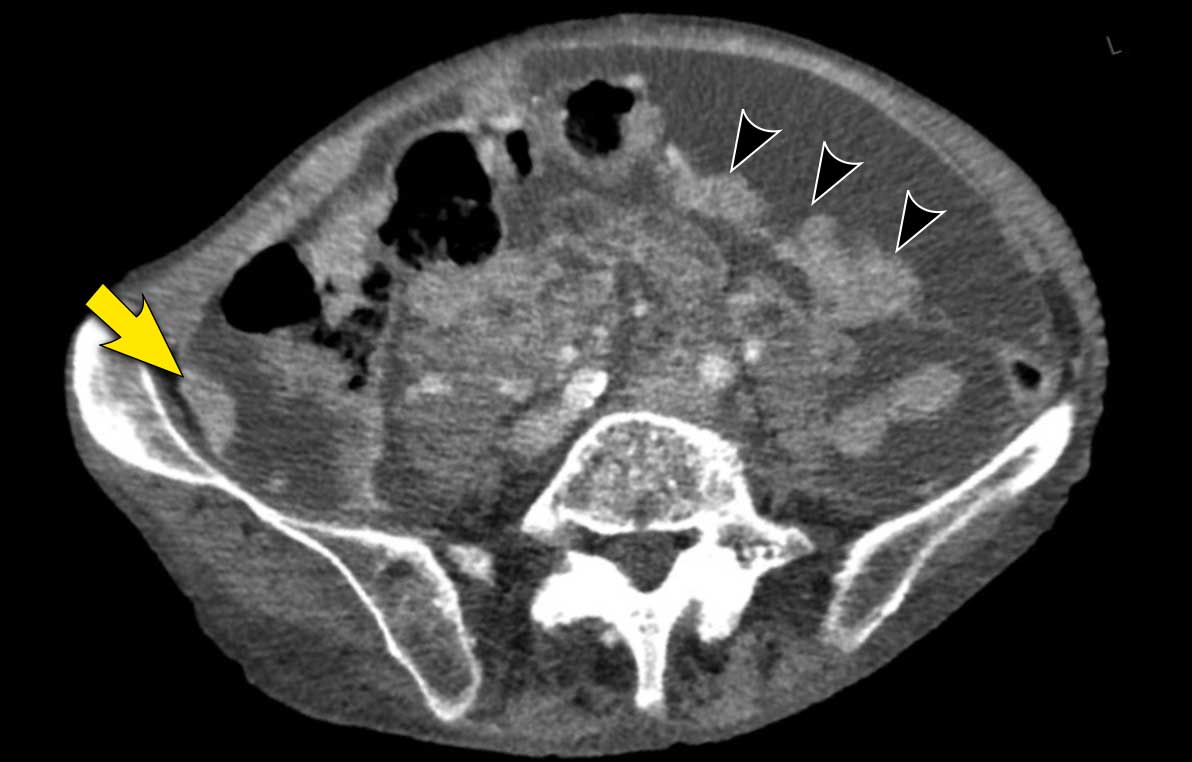 The Radiology Assistant : Peritoneal Carcinomatosis