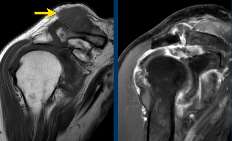 The Radiology Assistant Shoulder Rotator Cuff Injury