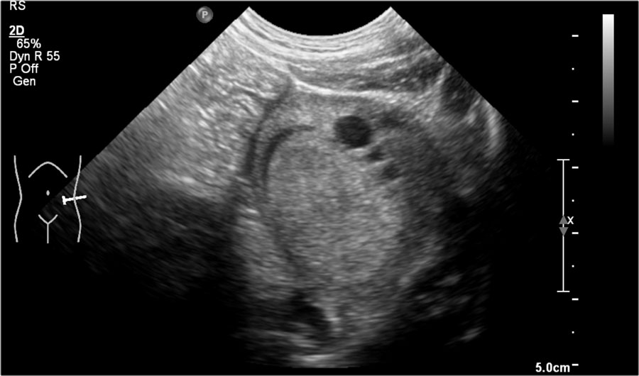 The Radiology Assistant : Cystic Abdominal Masses in Children