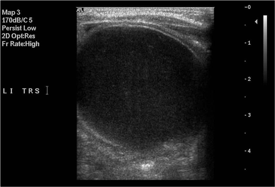The Radiology Assistant : Cystic Abdominal Masses in Children