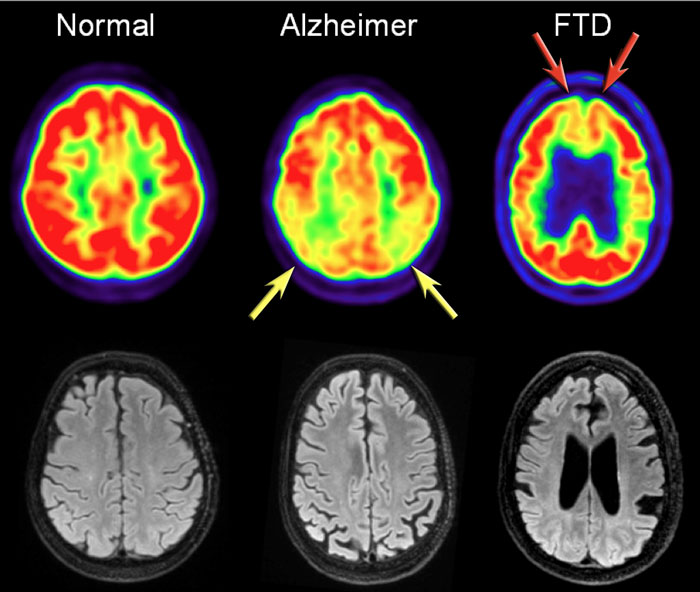 Dementia CT Scan