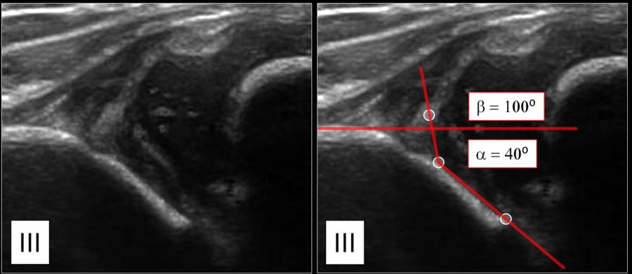 The Radiology Assistant : Developmental Dysplasia of the Hip