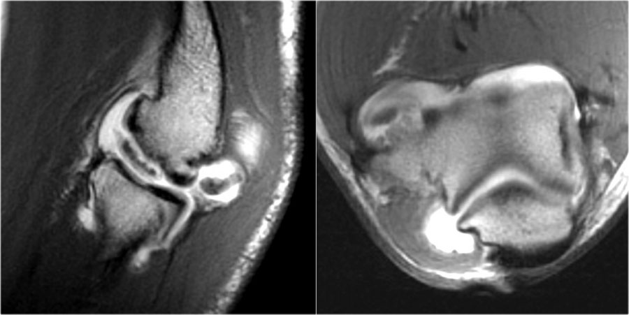 The Radiology Assistant : MRI examination of the Elbow