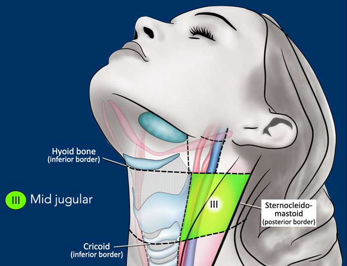 The Radiology Assistant : Cervical Lymph Node Map