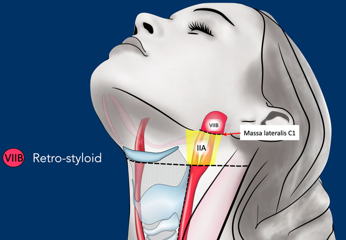 The Radiology Assistant : Cervical Lymph Node Map