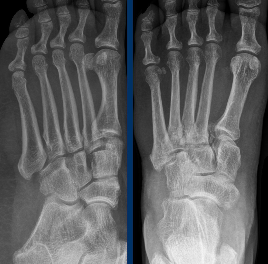 The Radiology Assistant : Foot and Ankle cases