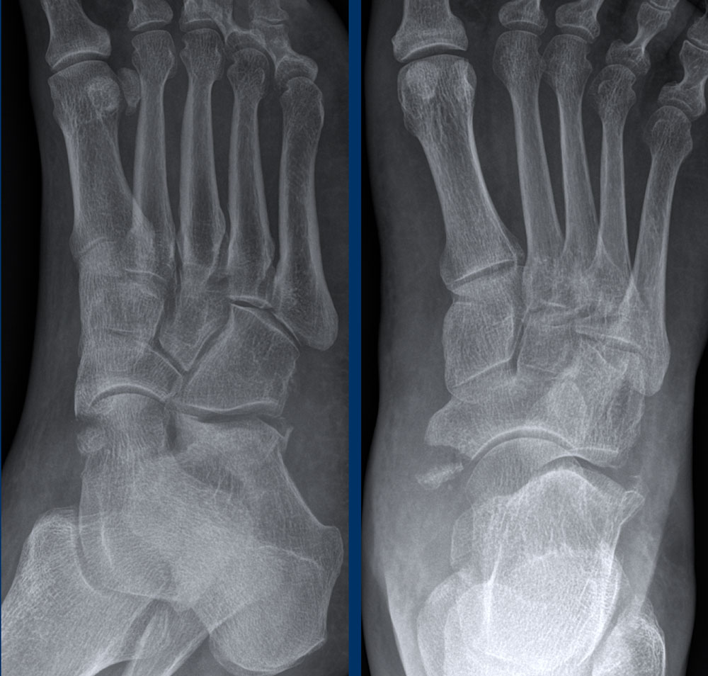 The Radiology Assistant : Foot and Ankle cases