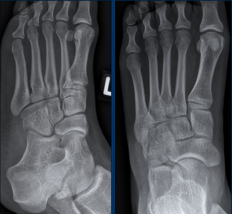 The Radiology Assistant : Foot and Ankle cases