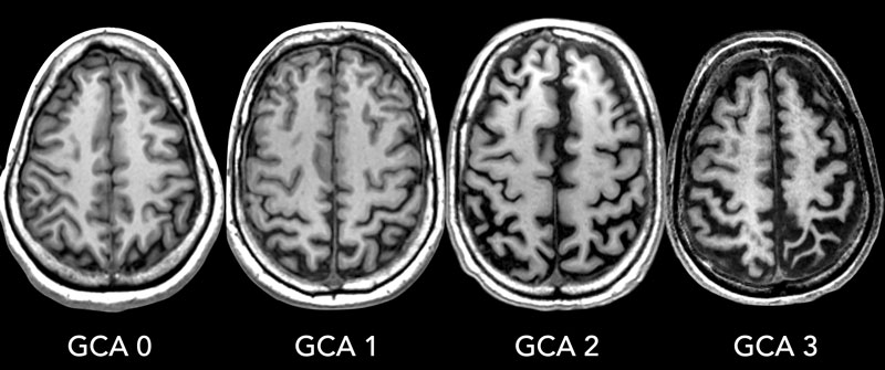 The Radiology Assistant : Dementia - Role of MRI