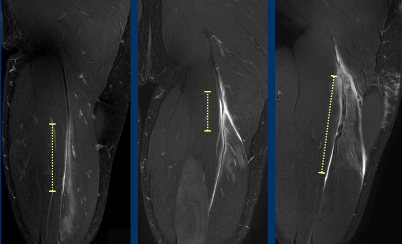 The Radiology Assistant : Hamstring injury
