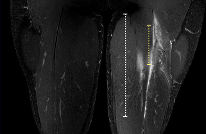 The Radiology Assistant : Hamstring injury