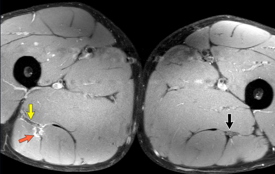 The Radiology Assistant : Hamstring injury