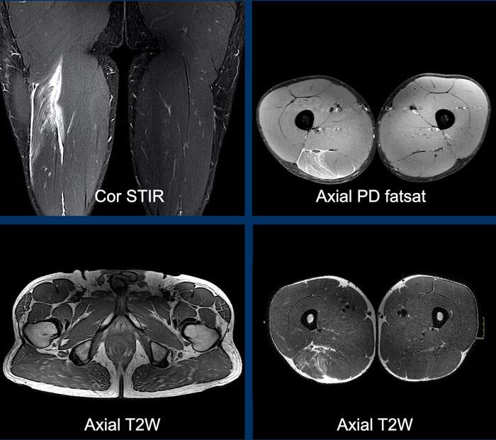 The Radiology Assistant : Hamstring injury