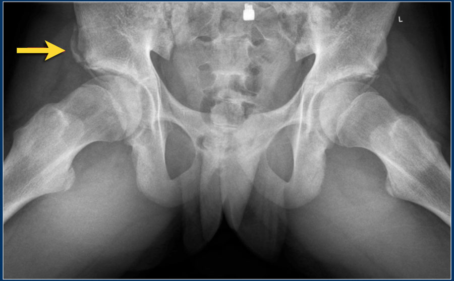 Can A Hip X Ray Show Cancer WOMANCR Can A Hip X Ray Show Cancer WOMANCR