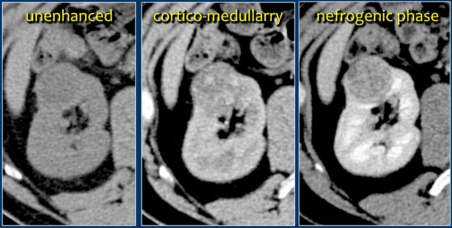 The Radiology Assistant : Kidney - Solid masses
