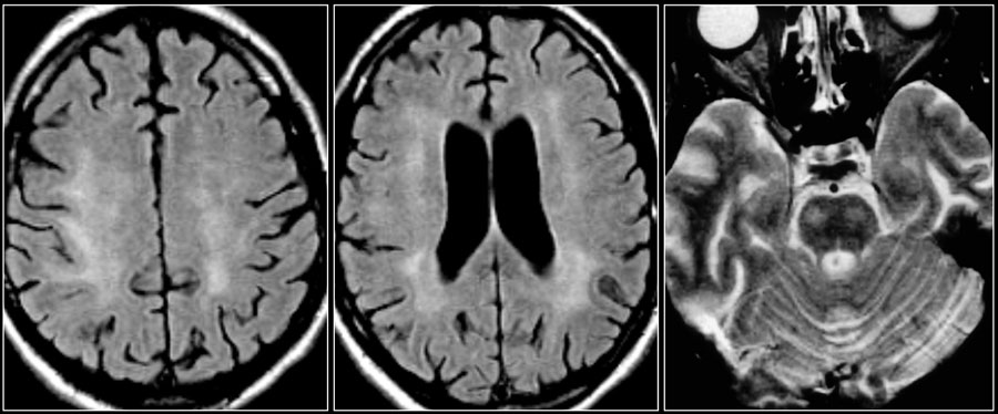 The Radiology Assistant : Multiple Sclerosis