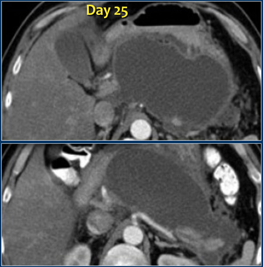 The Radiology Assistant : Acute Pancreatitis