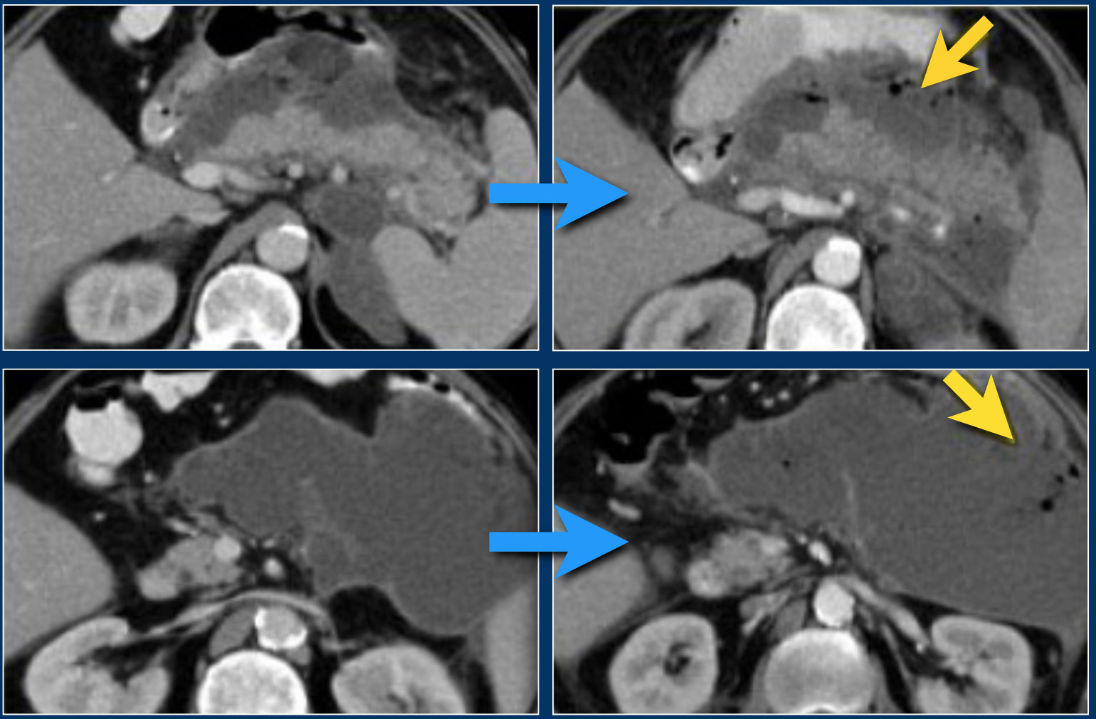The Radiology Assistant : Acute Pancreatitis