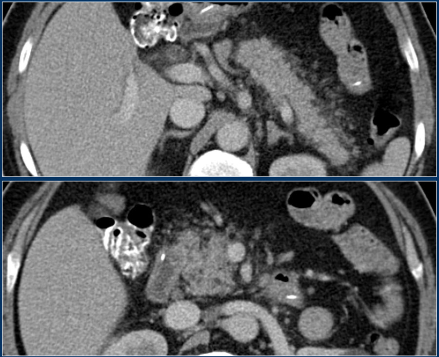 The Radiology Assistant : Acute Pancreatitis