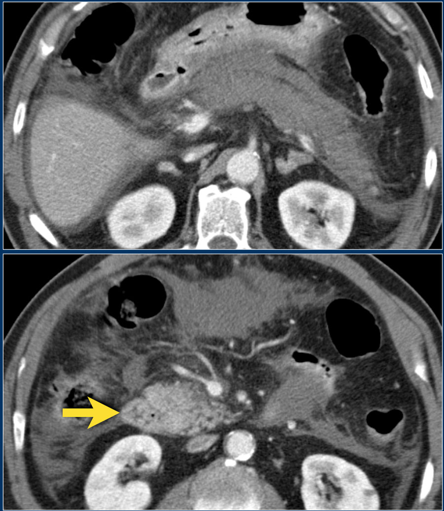 The Radiology Assistant : Acute Pancreatitis