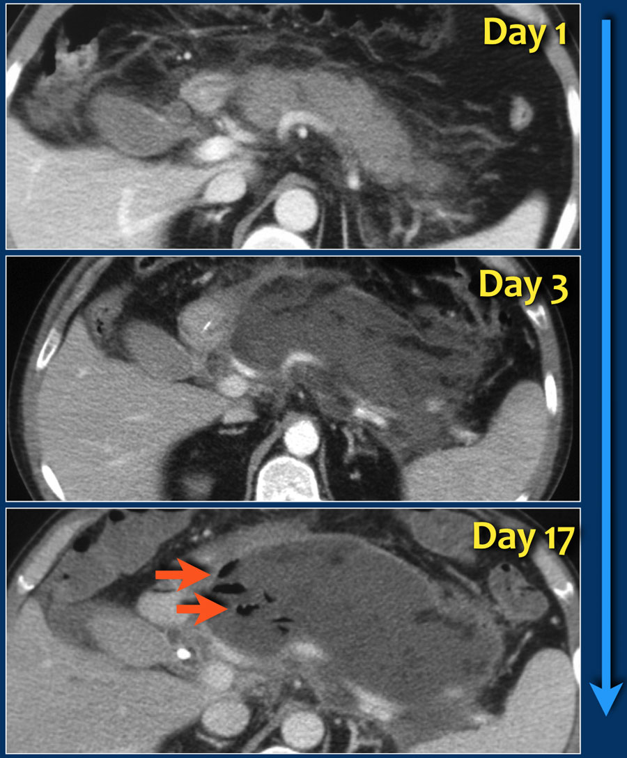 The Radiology Assistant : Acute Pancreatitis