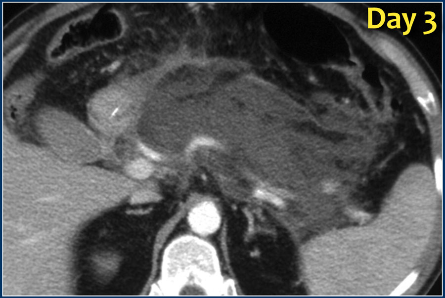 The Radiology Assistant : Acute Pancreatitis