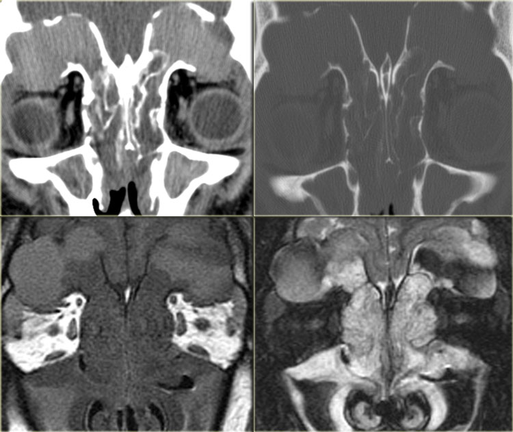 The Radiology Assistant : MRI of the Paranasal Sinuses