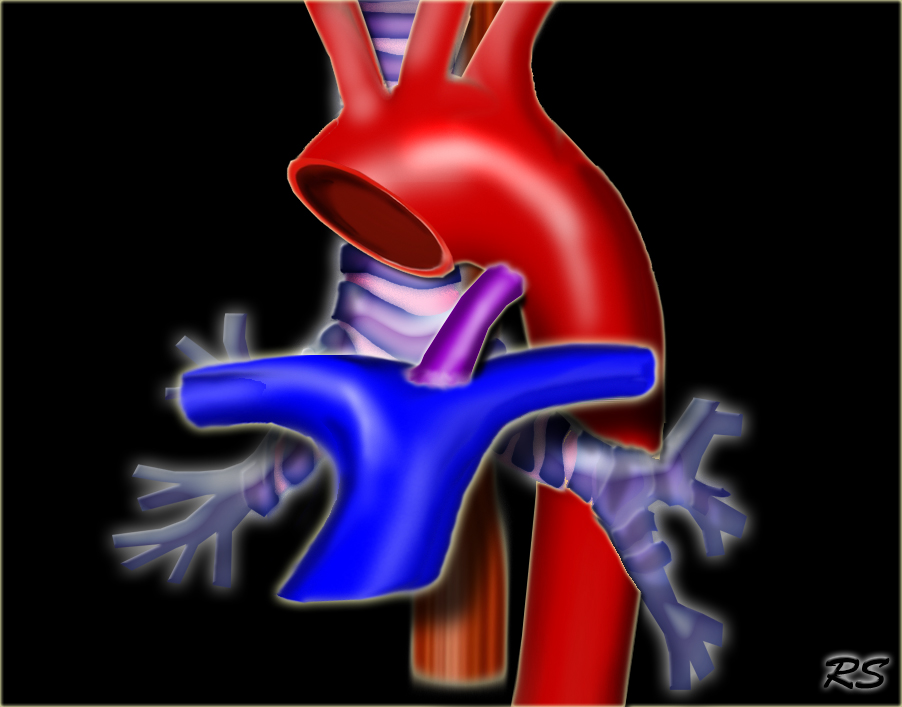 The Radiology Assistant : Pediatric Chest CT 2