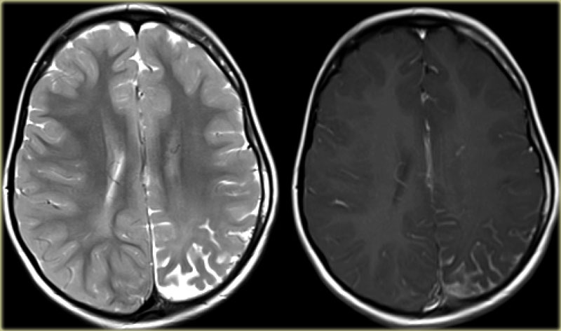 The Radiology Assistant : Epilepsy - Role of MRI