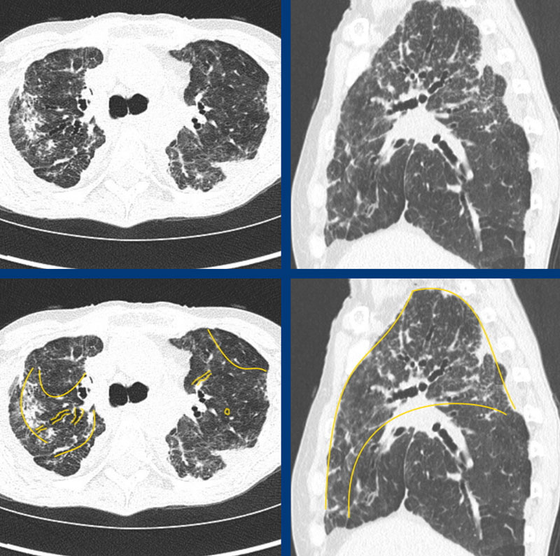 The Radiology Assistant : Pulmonary Fibrosis