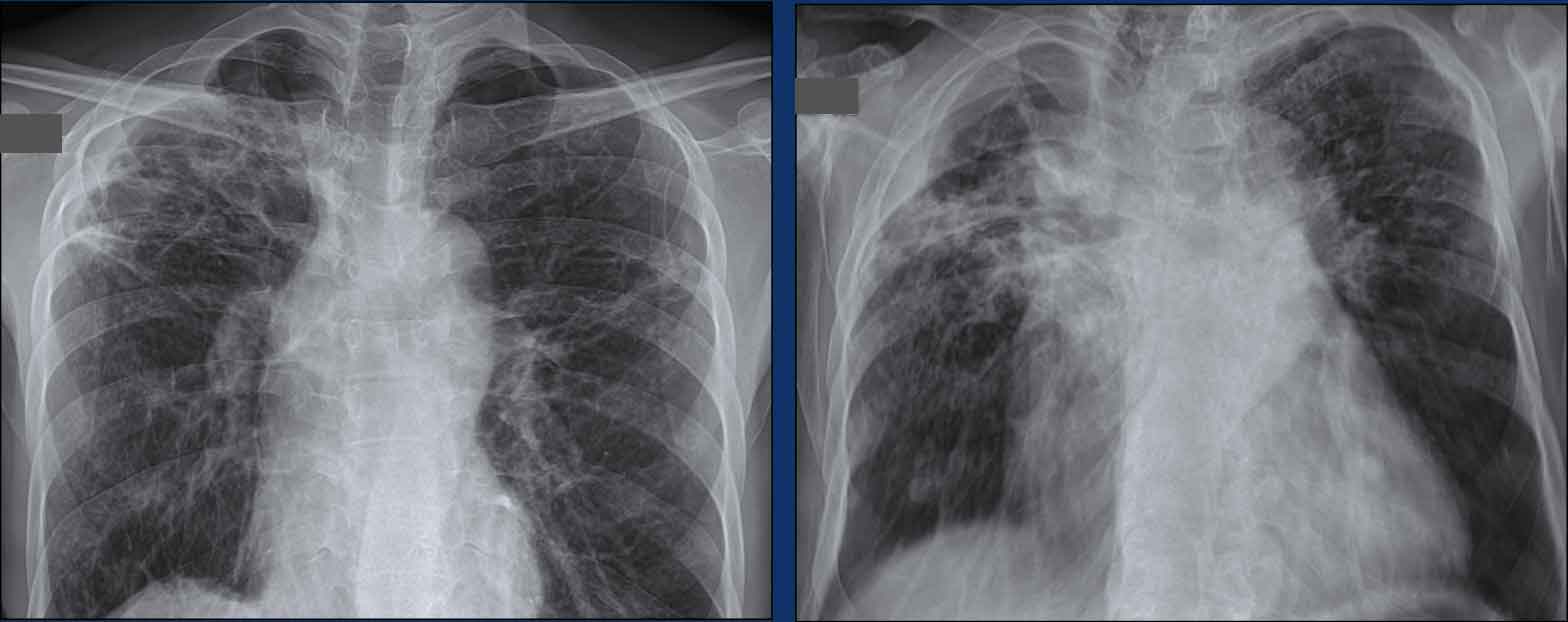 The Radiology Assistant : Imaging findings in TB