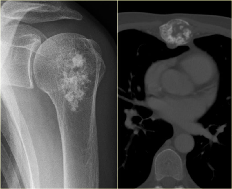 The Radiology Assistant Bone Sclerotic Tumors And Tumor like Lesions