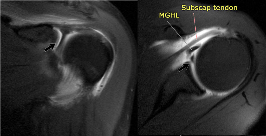 The Radiology Assistant : Shoulder MR - Anatomy