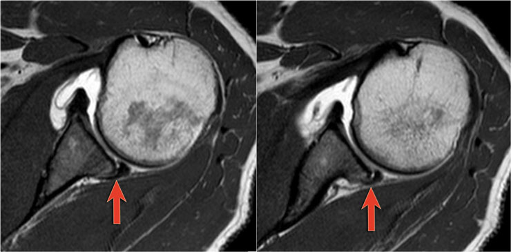 Bankart Lesion Mri Remplissage Austin TX Shoulder Arthroscopic Bankart Lesion Mri Remplissage Austin TX Shoulder Arthroscopic