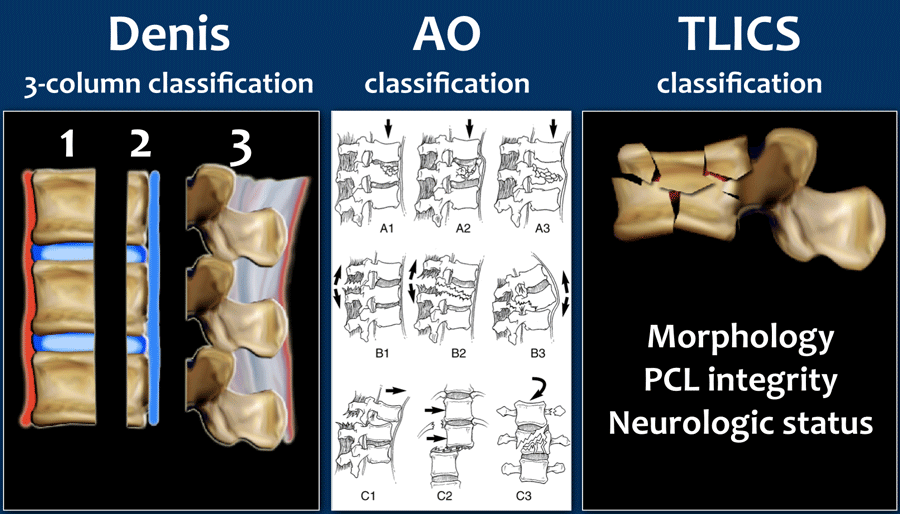 TLICS Vs AO Classification Of Thoracolumbar Fractures John 51 OFF TLICS Vs AO Classification Of Thoracolumbar Fractures John 51 OFF