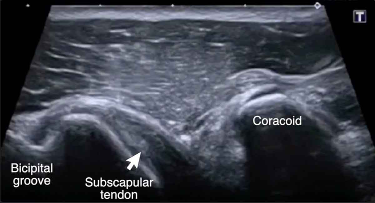 Subscapular Bursitis Ultrasound