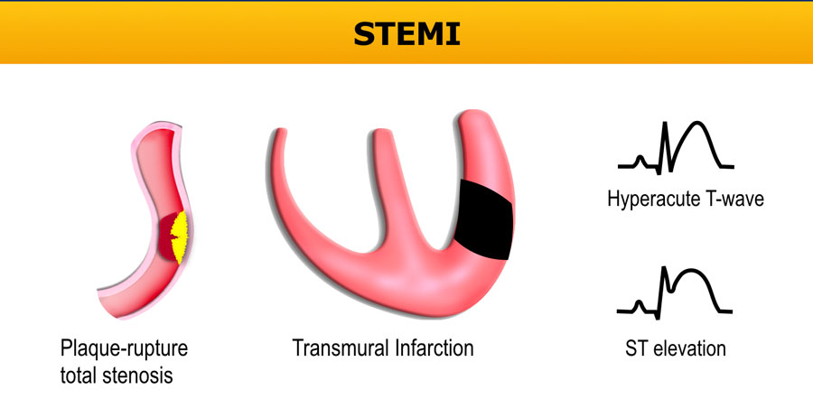 The Radiology Assistant : Coronary Artery Disease-Reporting and Data ...