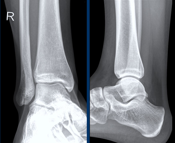 The Radiology Assistant : Foot and Ankle cases